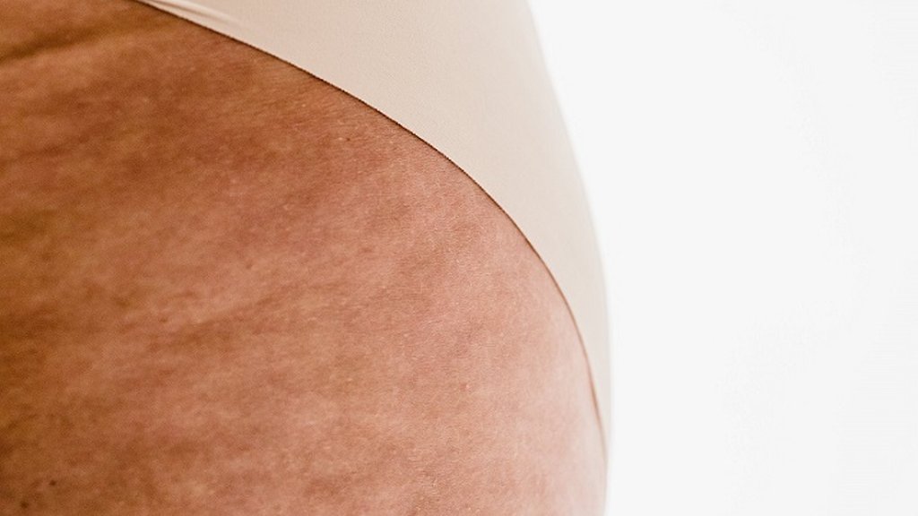 Wat kun je doen tegen cellulite?